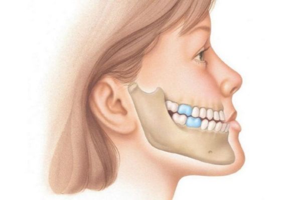 Mesial Bite - Symptoms, Causes, Treatment, Diagnosis, and Classification